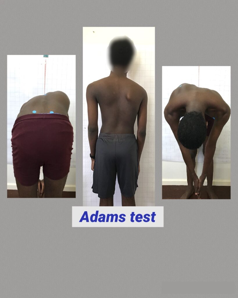 Scoliosis – Scolio Physio Caribbean