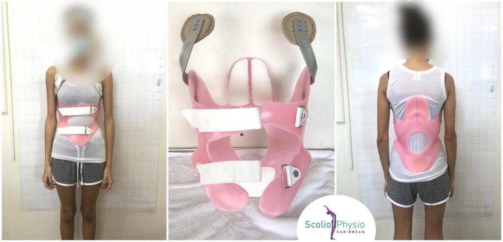 Kyphologic brace – Scolio Physio Caribbean